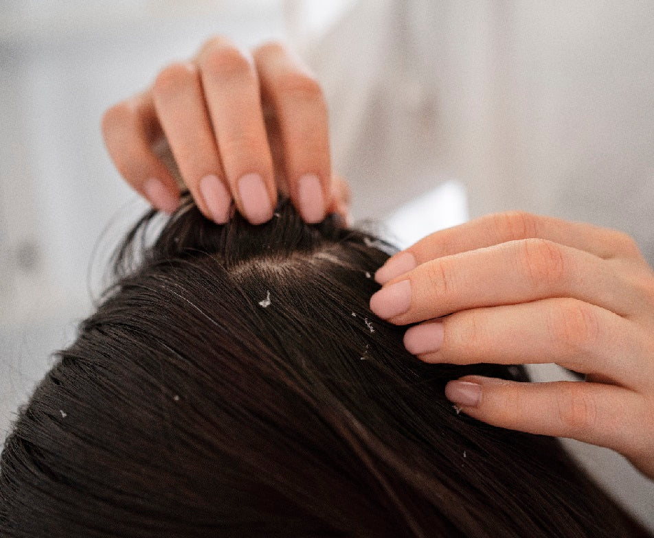 Understanding Dandruff and Its Treatments – Moonspells Beauty