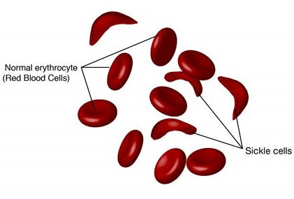 Sickle Cell Anemia Potential Cures – Moonspells Beauty